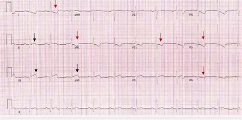 Ekg Showing Inferior Stemi Ekg Showing St Segment Elevation In Leads