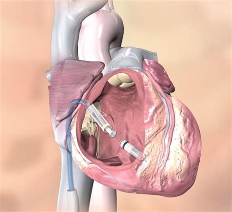 Micra Pacemaker Cost In Seawoods Mumbai