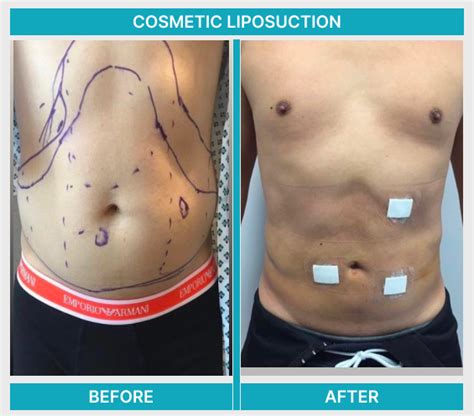 Liposuction Surgery Fat Removal Surgery In Uk Dr Damir