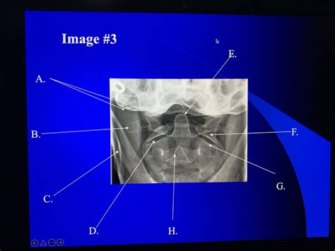 Odontoid Labeling Diagram Quizlet