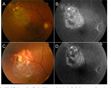 Figure 1 From Choroidal Neovascularization Complicating Sclerochoroidal