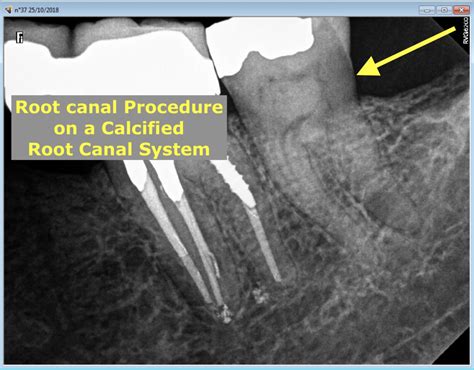 Guided Endodontics Endomontreal