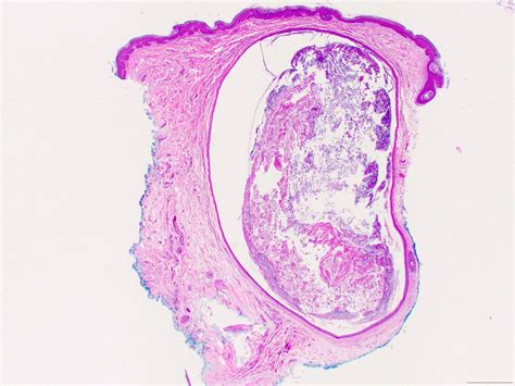 Epidermal Inclusion Cyst Cytology Dog 3 Common Types Of Hand Tumors