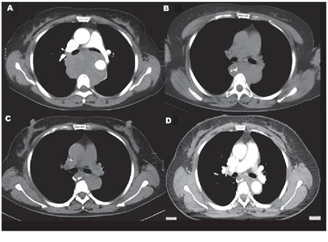 Figure 2 From Extraskeletal Ewings Sarcoma Primitive Neuroectodermal Tumor Of The Mediastinum
