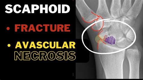 Scaphoid Fracture Avascular Necrosis