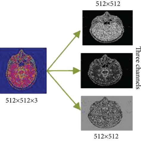 PDF An Improved Brain MRI Classification Methodology Based On Statistical Features And Machine
