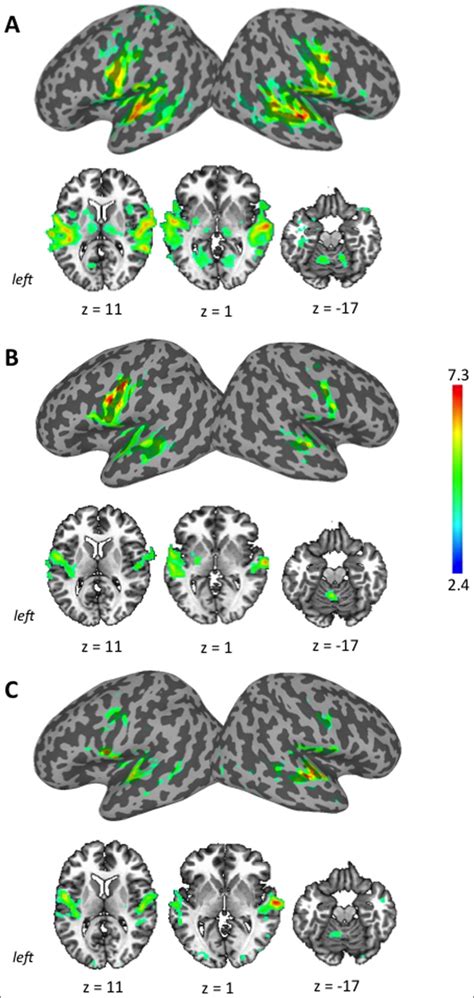 Before Treatment With Sodium Oxybate A 90 Minutes After Treatment Download Scientific