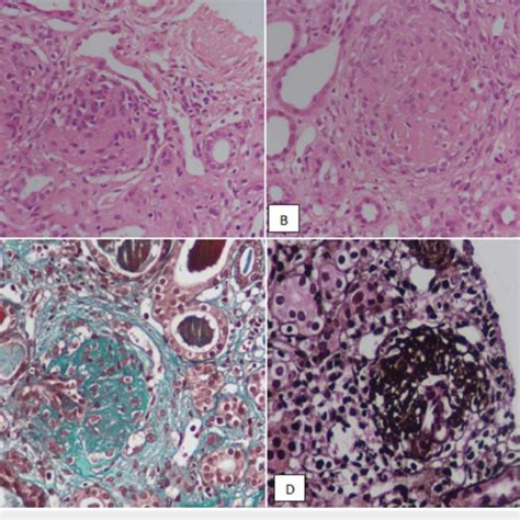Class Ii Lupus Nephritis A Hematoxylin And Eosin Staining At ×400 Download Scientific