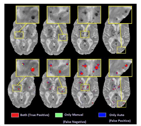 Figure Axial Slices Comparing Automated And Manual Segmentations