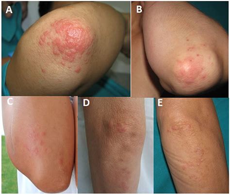 Frontiers Summer And Spring Elbow Rashes Is A Variant Of Polymorphous