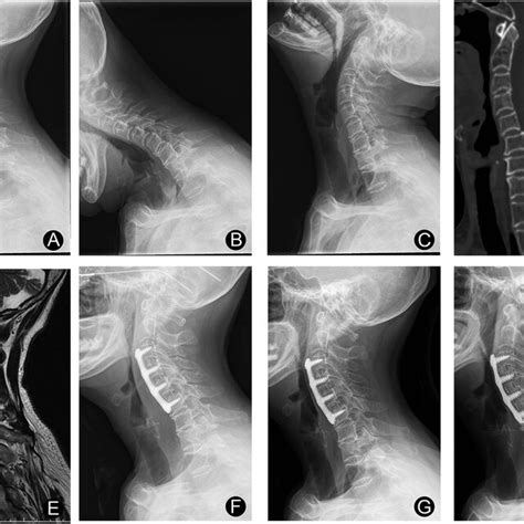 Male 57 Years Old C3 4 Acdf Was Experienced A C Cervical Spine Download Scientific Diagram