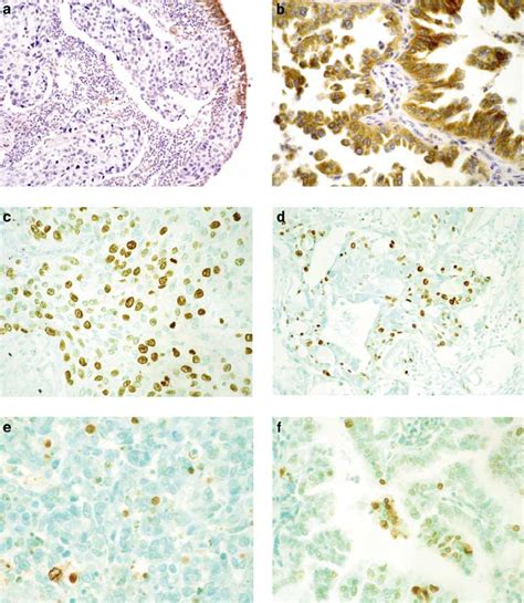 Photomicrographs Of SCCs Left And ACs Right Of The Lung A And B Download Scientific