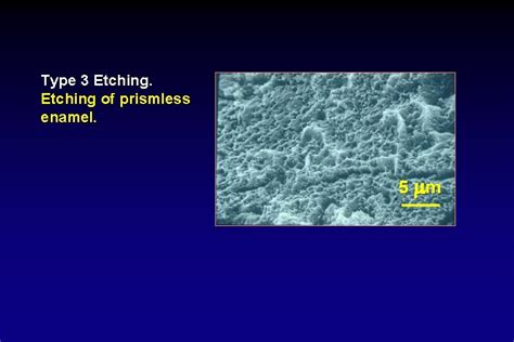 Bonding To Enamel Enamel Bonding History Toothcolored MMA