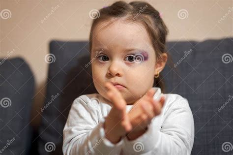 Little Cute Girl With Contusion Or Hematoma Symptom On The Face After