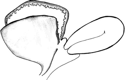 Supratrigonal Vvf Repair By Modified Oconnors Technique An