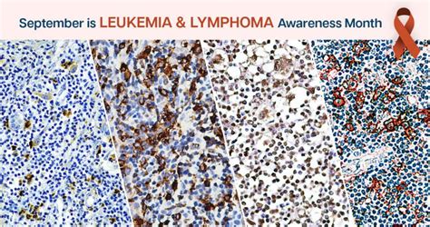Biogenex Helping Leukemia And Lymphoma Biogenex Posted On The Topic Linkedin