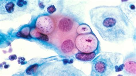 ¿qué Es La Clamidia Cómo Se Contrae Y Qué Síntomas Tiene