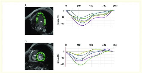 representative cmr feature tracking showing long axis a and