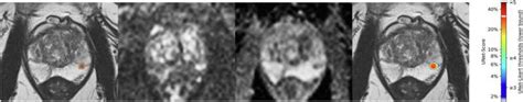 Prostate Cancer Can Ai Help To Avoid Unnecessary Biopsies