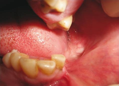 Hemimandibulectomy On The Left Side Download Scientific Diagram