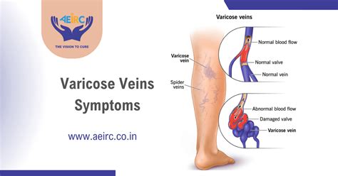 Varicose Veins Symptoms Signs Causes And Treatment Aeirc