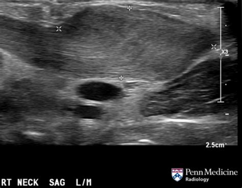 Infant With Neck Mass Auntminnie