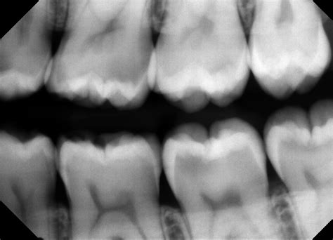 Closing The Gap In Direct Dentistry Treating Black Triangles Optident