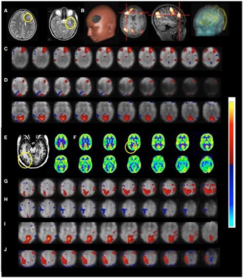 Presurgical Mapping In Two Patients With Epilepsy Resting State Fmri