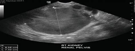 A Rare Case Of Pyonephrosis In An Infant Induced By Extended Saudi Journal Of Medicine