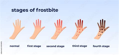 Frostbite Stages Hypothermia In Cold Season Medical Infographic Blue And Red Fingers