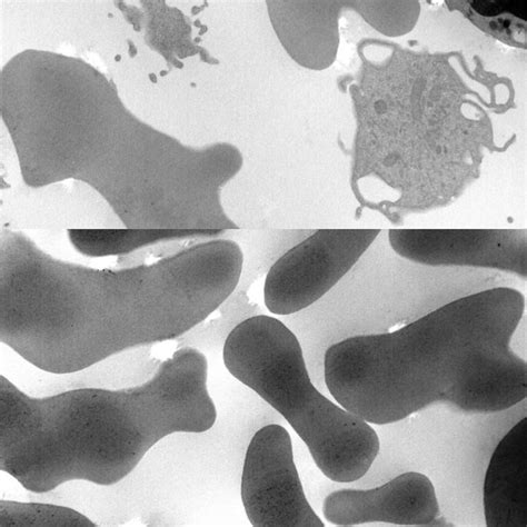 Electron Microscopy Images Showing Erythrocytes With Thick Cytoplasmic Download Scientific