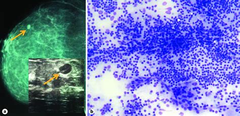 A Mammographic And Ultrasound Inset Features Of Intramammary Lymph Download Scientific