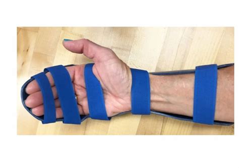 Cream Dorsal Blocking Splint Medium Model Namenumber 1245 At ₹ 2750piece In Surat