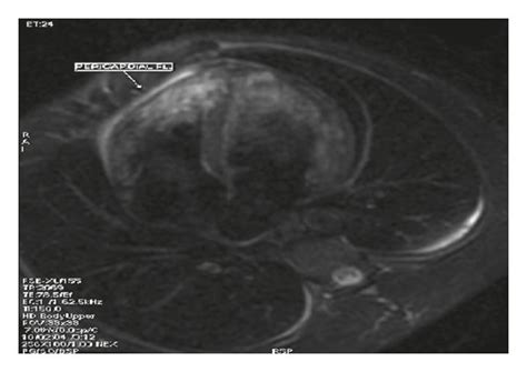 Small Bilateral Pleural Effusion And Localized Pericardial Effusion