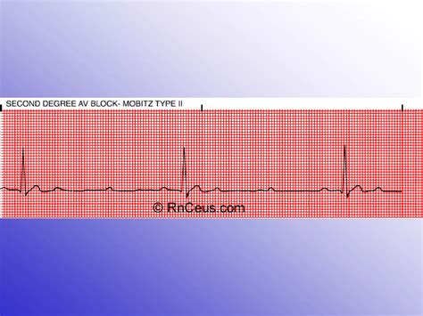 Arrhythmia Diagnosis And Management Ppt