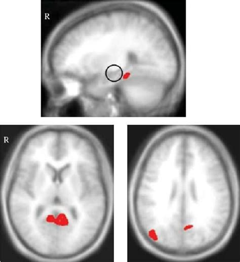brain regions activated in the comparison of all remote spatial memory