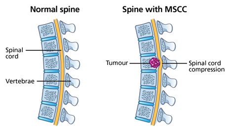Metastatic Spinal Cord Compression South Tees Hospitals Nhs