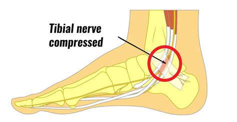 발바닥 통증 이중에 하나일겁니다 통풍 무지외반증 지간신경종 족저근막염 아킬레스건염 네이버 블로그