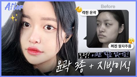 윤곽성형 브이로그 광대사각턱앞턱지방이식 흔녀에서 인스타 얼짱되기💘 Youtube