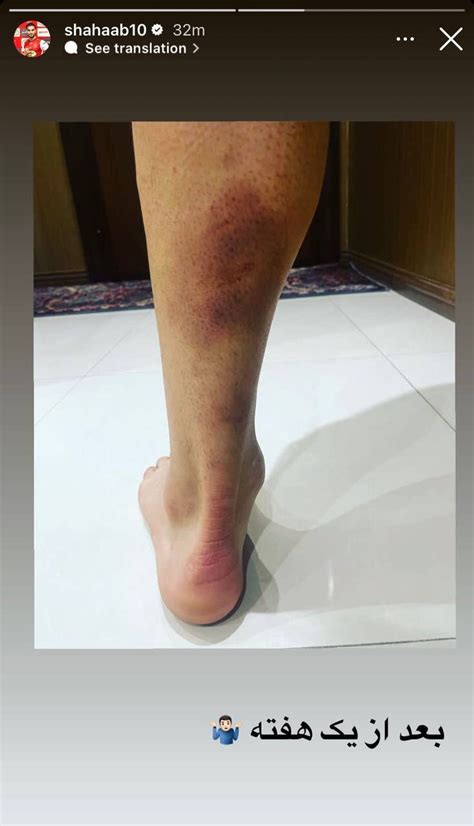 عکس‌ اعتراض خلاقانه یک پرسپولیسی؛ رونمایی از تصویر کبودی پا و لحظه