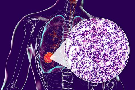 A Combination Approach For Egfr Positive Lung Cancer Cancer Today