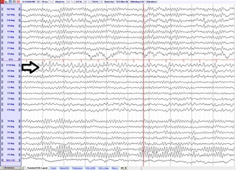 EEG Midterm Flashcards Quizlet