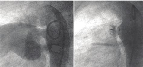 Device Closure Of PDA Download Scientific Diagram