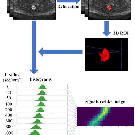 Example Of Tumor Delineation On Diffusion Weighted Images And The