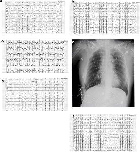 A The Ecg Showed Sinus Rhythm Hr 98 Bpm Frequent Atrial Premature Download Scientific