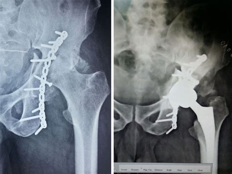 Hip Replacement Surgery Jaipur Dr Lalit Modi Hip Joints Surgeon