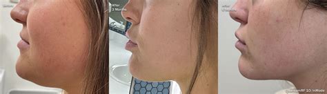 Quantumrf Skin Tightening And Contouring Mclean Va Evexia Medspa