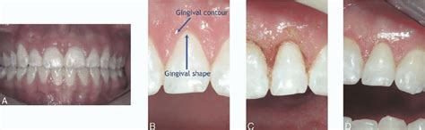 A Patient Had Finished Treatment 1 Year Earlier And Still Had