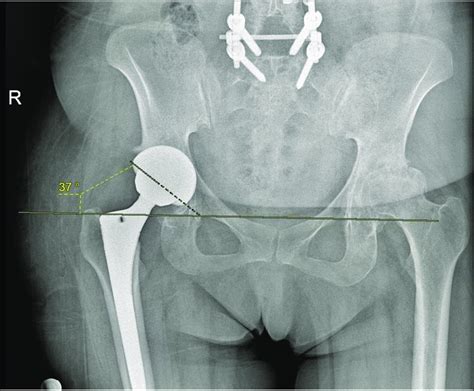 Evaluation Of Radiographic Measurements Of Acetabular Component