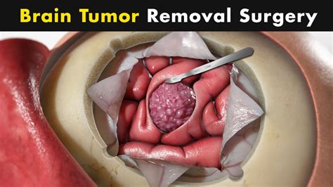 Brain Tumor Surgery Video